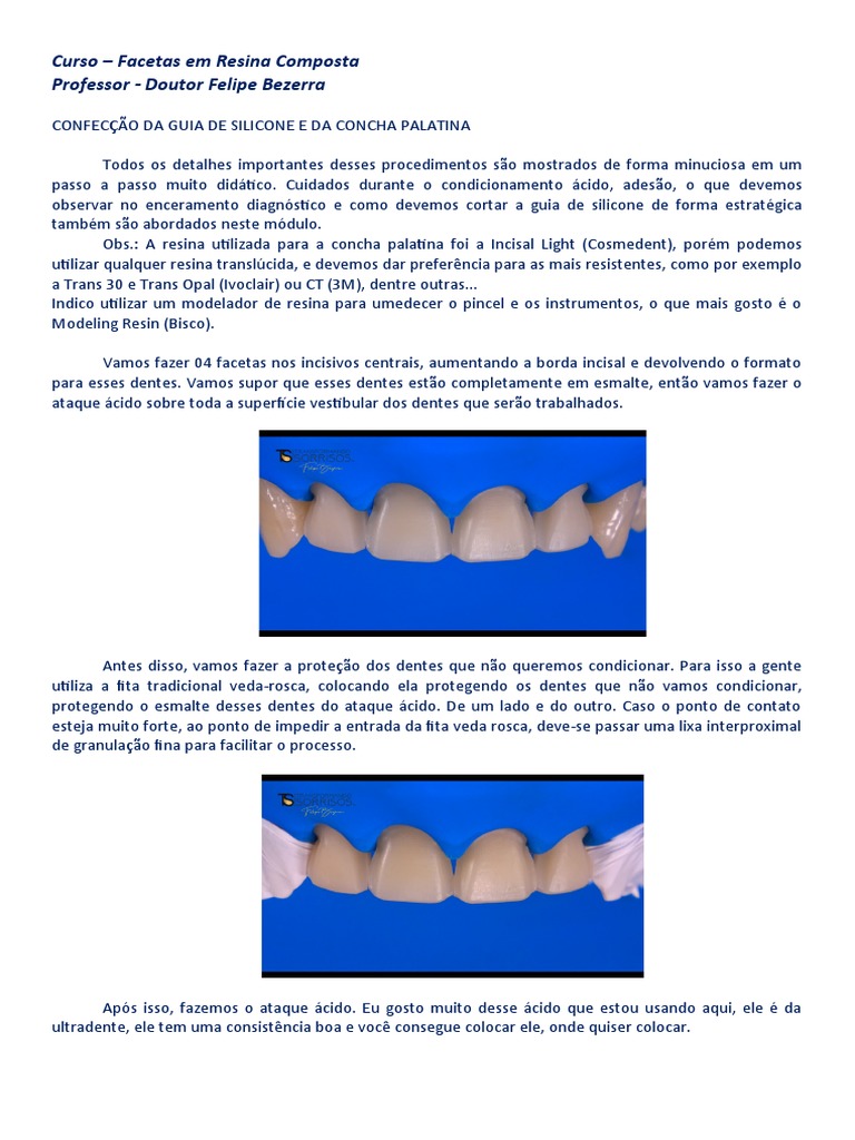 Curso - Facetas em Resinas Compostas - Felipe Bezerra | PDF | Dente ...