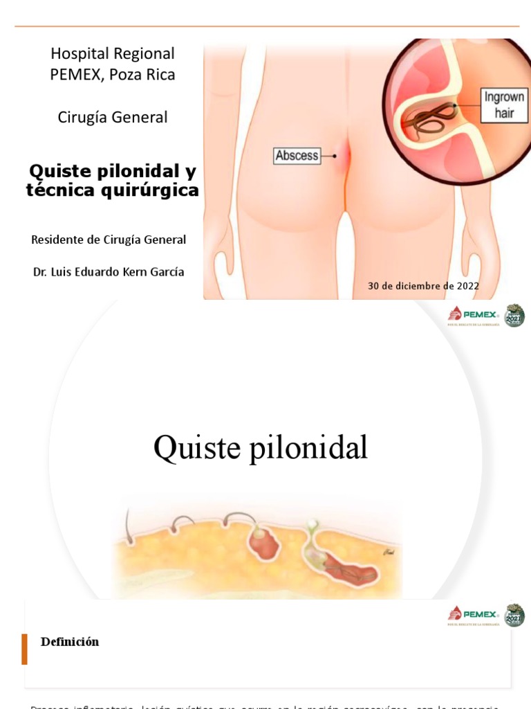 Quiste-Pilonidal - Luis Eduardo Kern García | PDF | Diagnostico medico | Especialidades Medicas