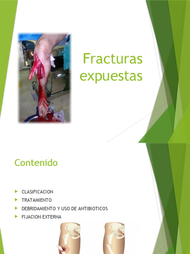 Fracturas Expuestas | PDF | Herida | Ciencias de la Salud