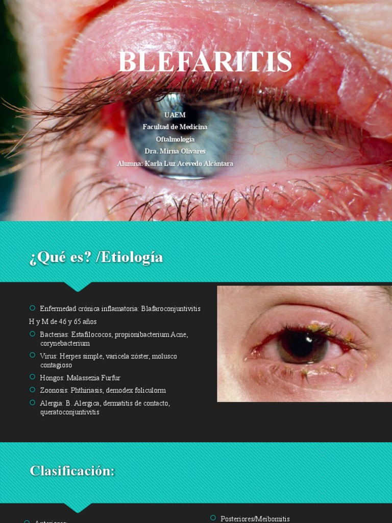 Blefaritis | PDF | Causas de la muerte | Inmunología