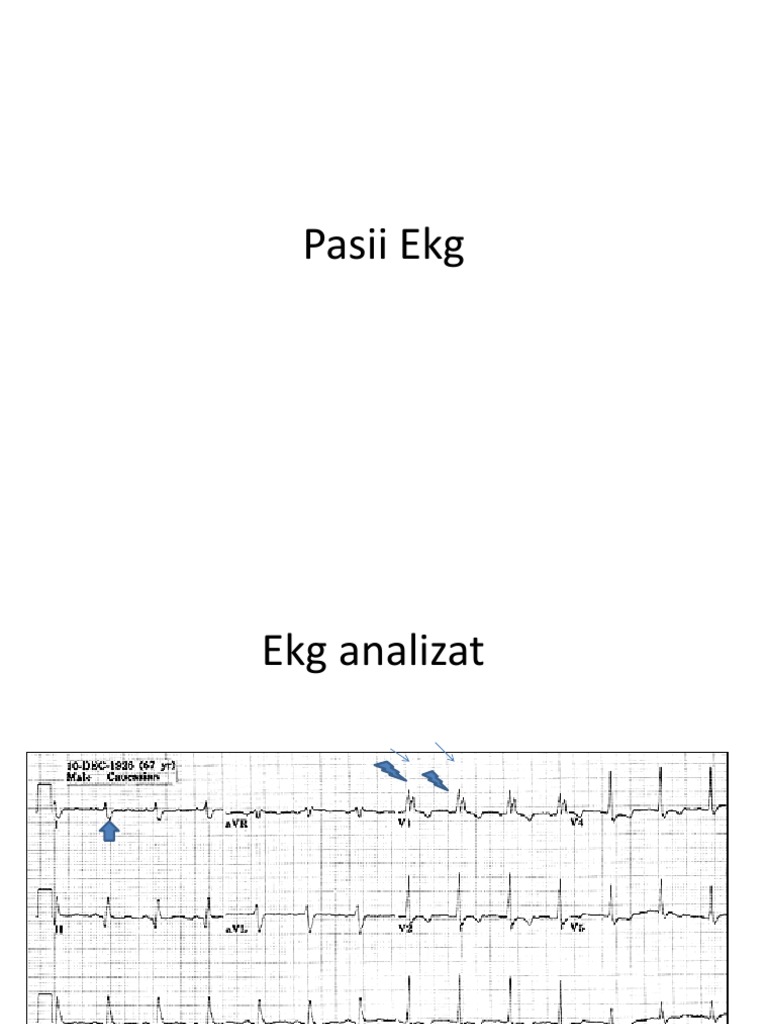 Pasii Ekg | PDF