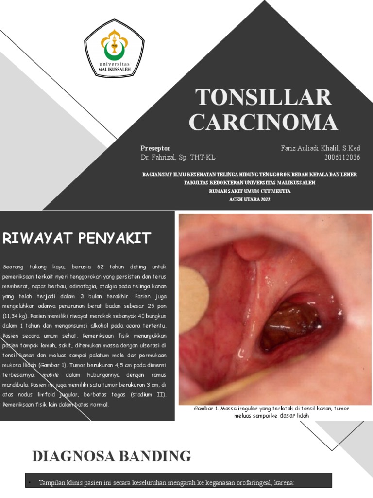 Tonsillar Carcinoma | PDF