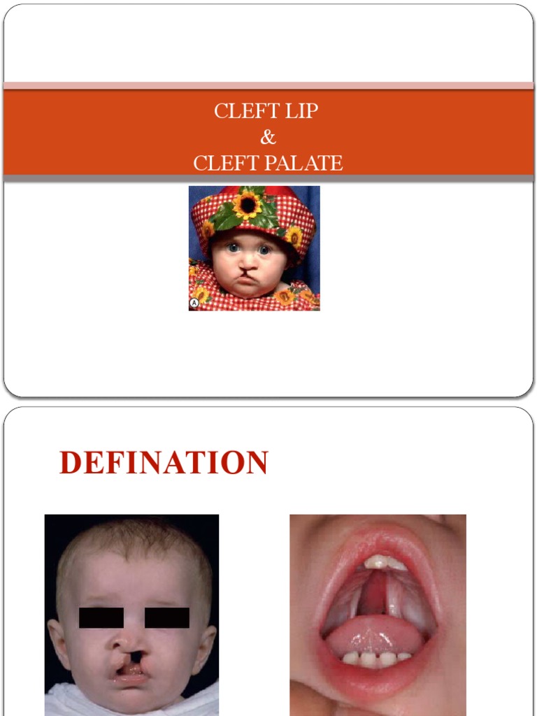 Cleft Lip and Palate | PDF | Medical Specialties | Facial Features