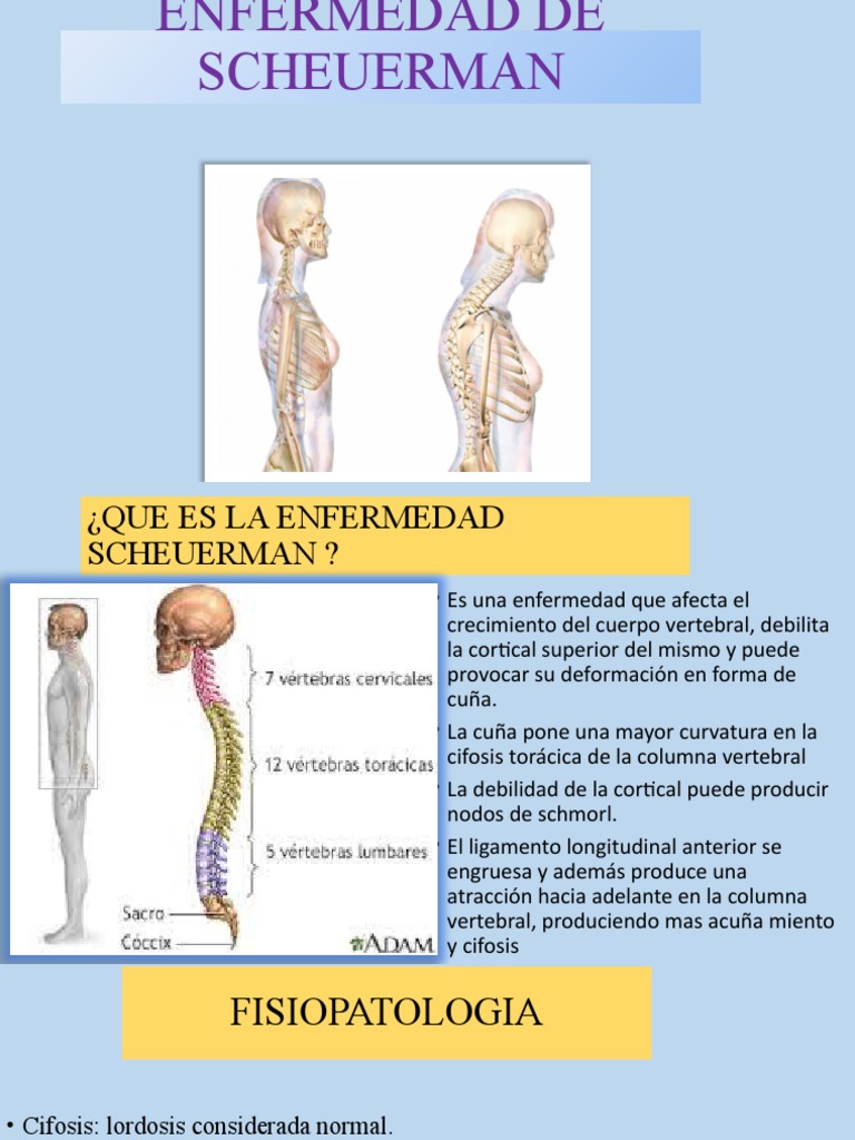 Enfermedad de Scheuerman | PDF | La columna vertebral | Especialidades ...