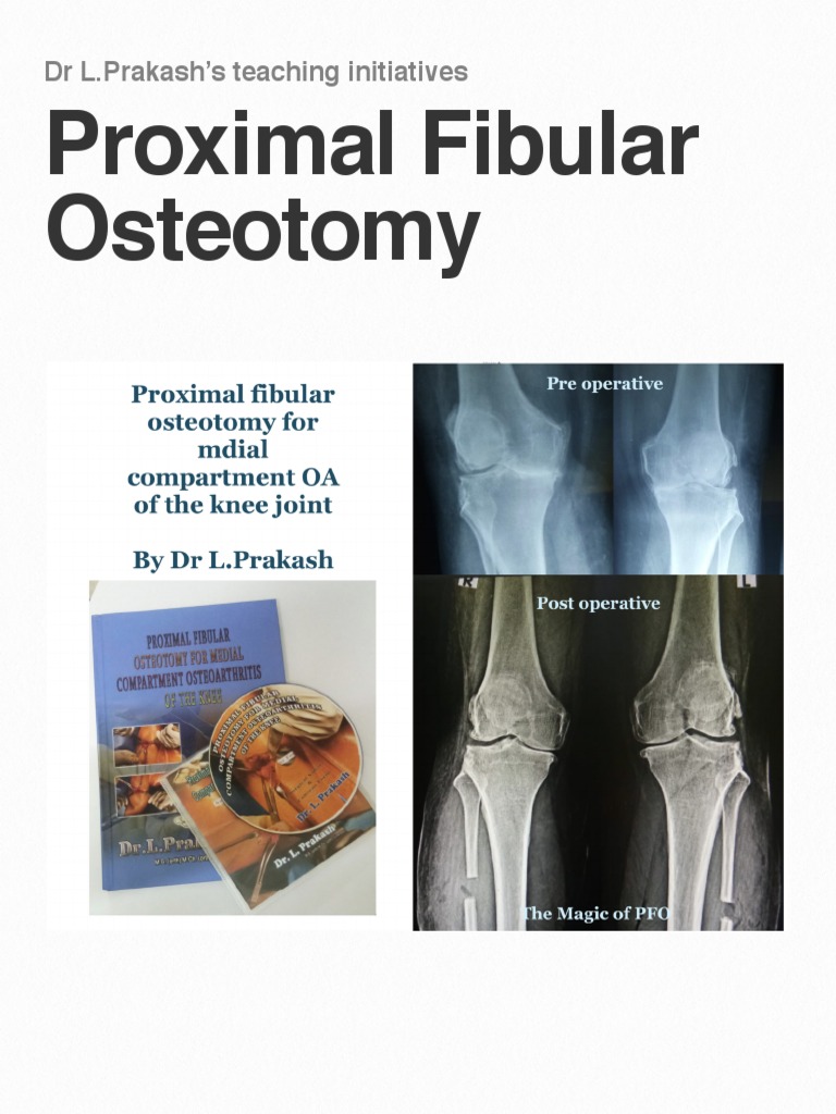 PFO Update | PDF | Knee | Surgery