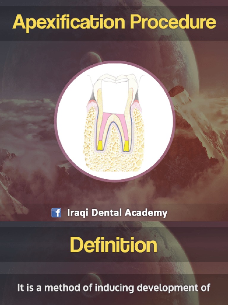 Apexification Procedure Rashed | PDF