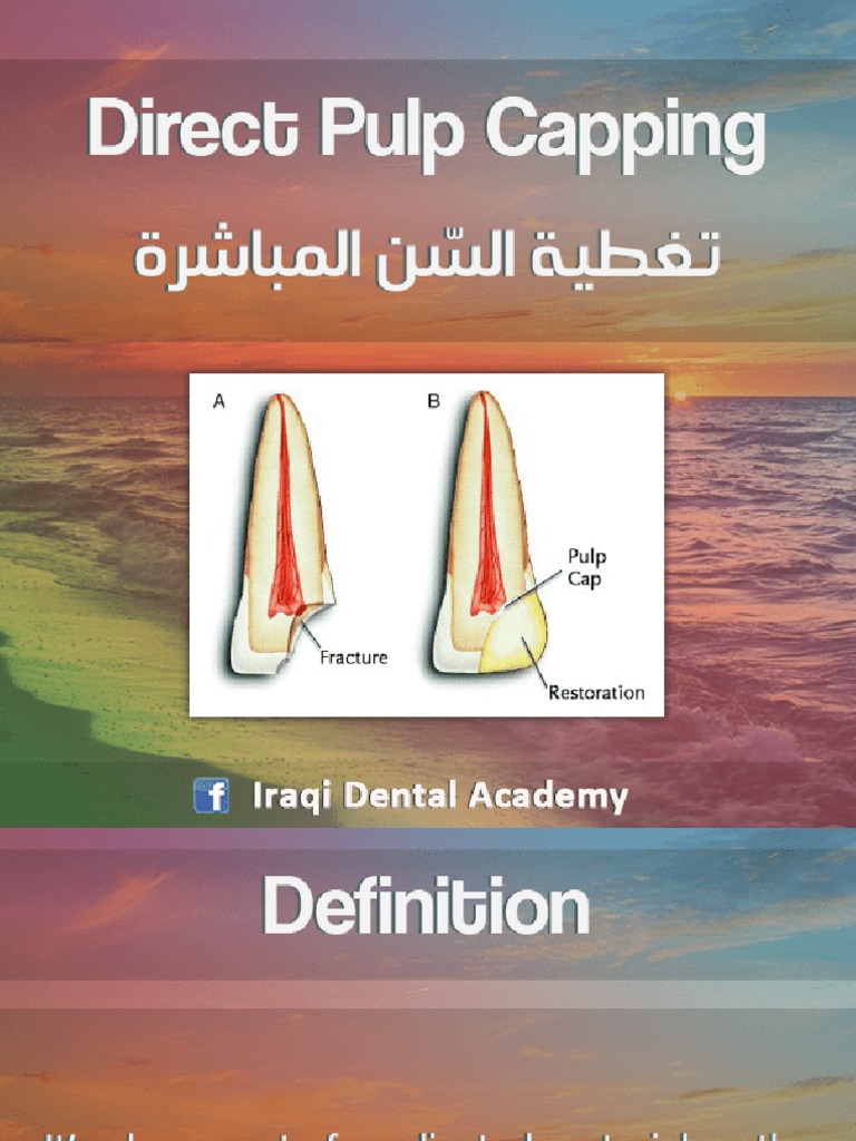 Direct Pulp Capping | PDF