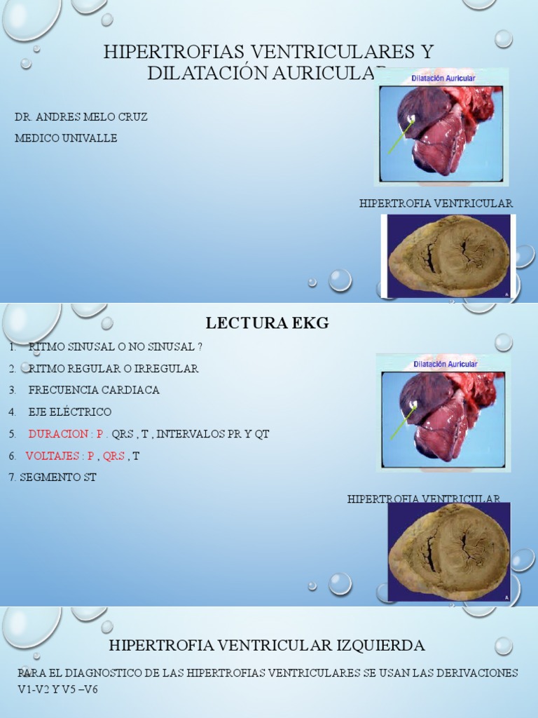 Hipertrofia Ventricular - Dilatacion Auricular | PDF ...