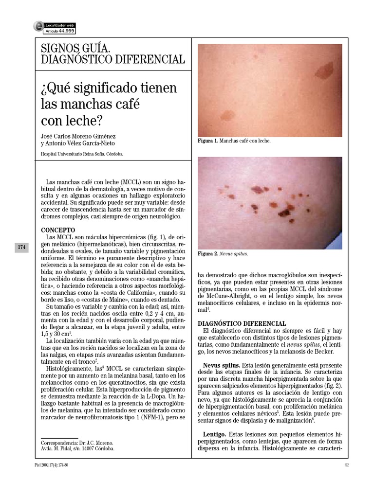 ¿Qué Significado Tienen Las Manchas Café Con Leche?: Signos Guía ...