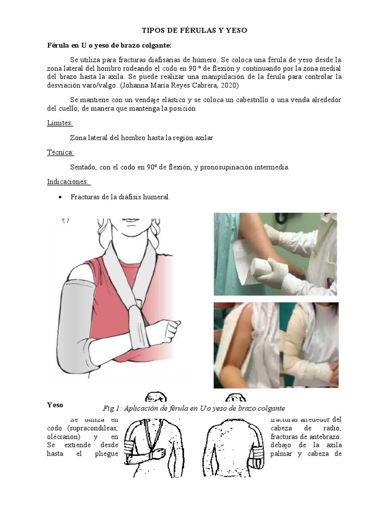 Tipos de Yeso y Férulas para Fracturas | PDF | Codo | Extremidades (anatomía)