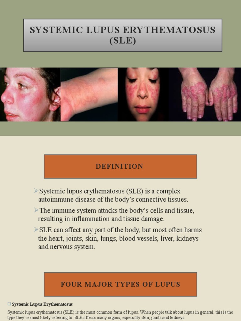 Systemic Lupus Erythematosus | PDF | Medicine | Diseases And Disorders