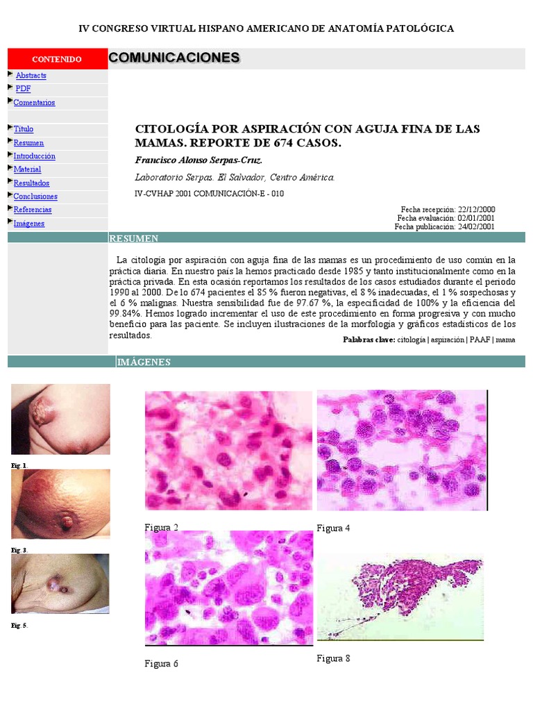 Citología Por Aspiración Con Aguja Fina de Las Mamas. Reporte de 674 ...