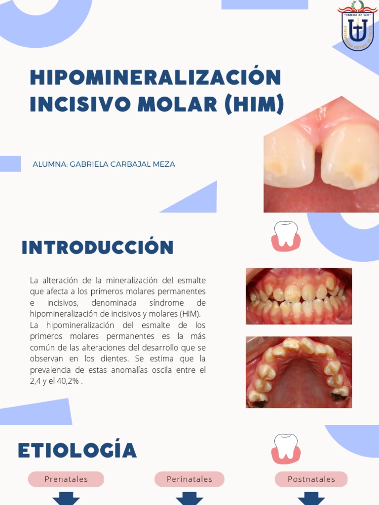 HIPOMINERALIZACIÓN INCISIVO MOLAR (Him) - 2 | PDF | Especialidades ...