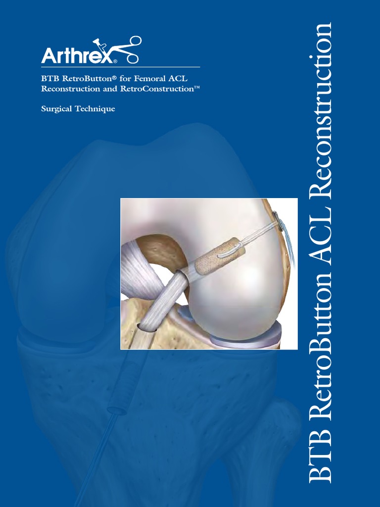 Arthrex BTB RetroButton® For Femoral ACL | PDF | Lower Limb Anatomy ...