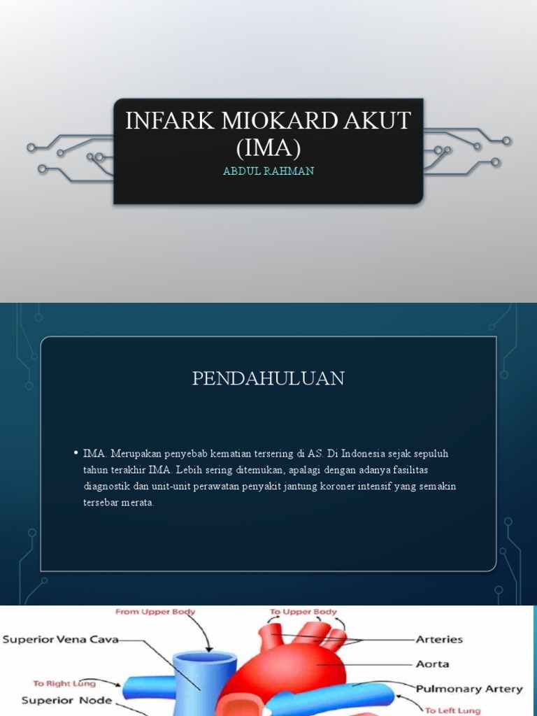 Infark Miokard Akut | PDF