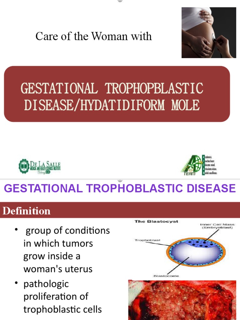 Hydatidiform Mole | PDF | Diseases And Disorders | Human Reproduction