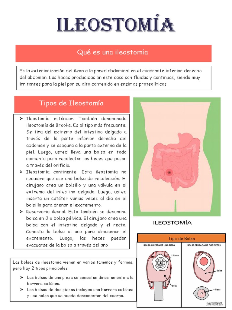 Ileostomia | PDF | Heces | Abdomen