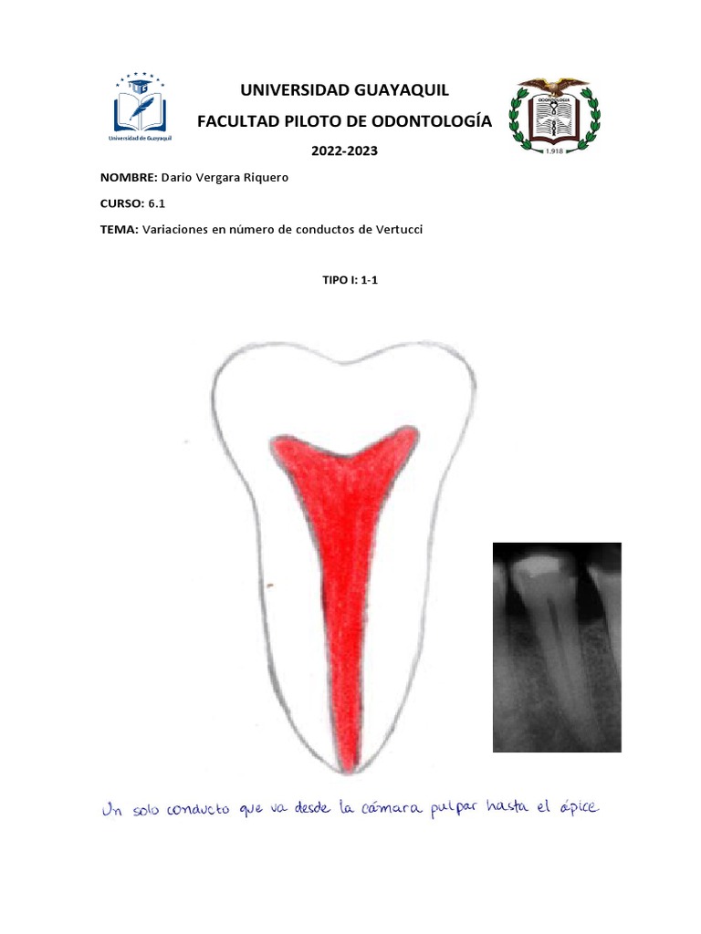 Endodoncia Vertucci | PDF