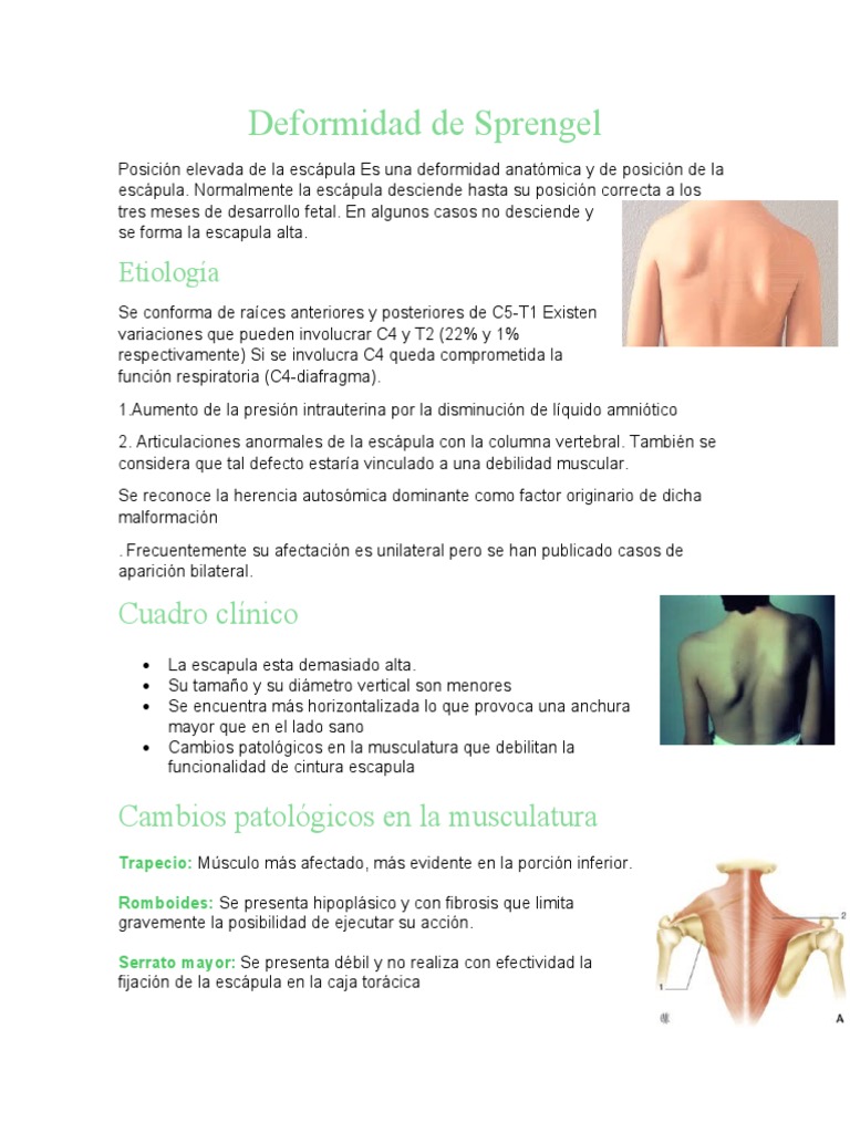 Deformidad de Sprengel | PDF | Hombro | Enfermedades y trastornos