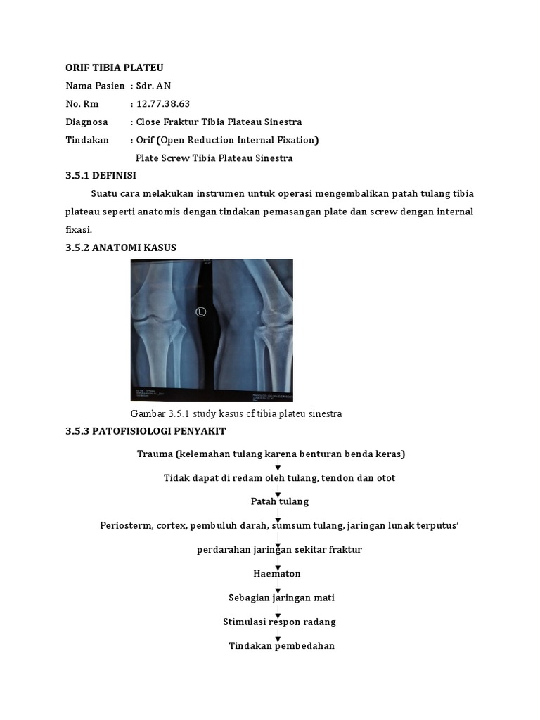 Orif Tibia Plateu | PDF