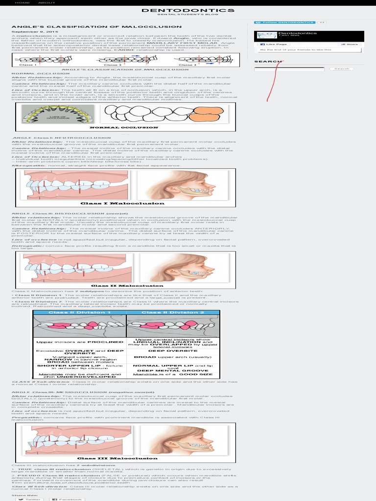 Angle's Classification of Malocclusion Dentodontics | PDF