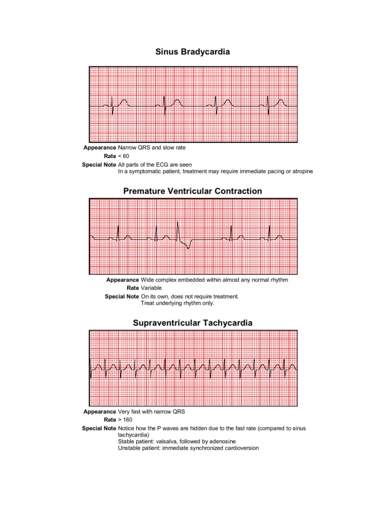 ACLS Rhythms | PDF