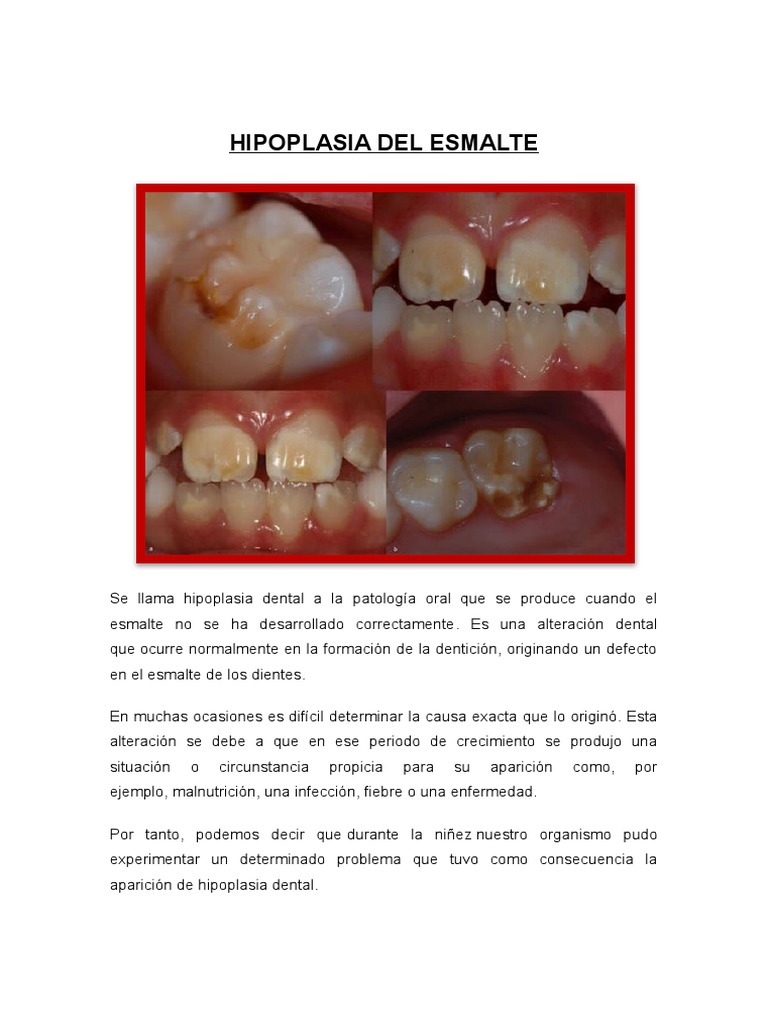 Patologias Del Esmalte y Pulpa Dental | PDF | Odontología | Diente