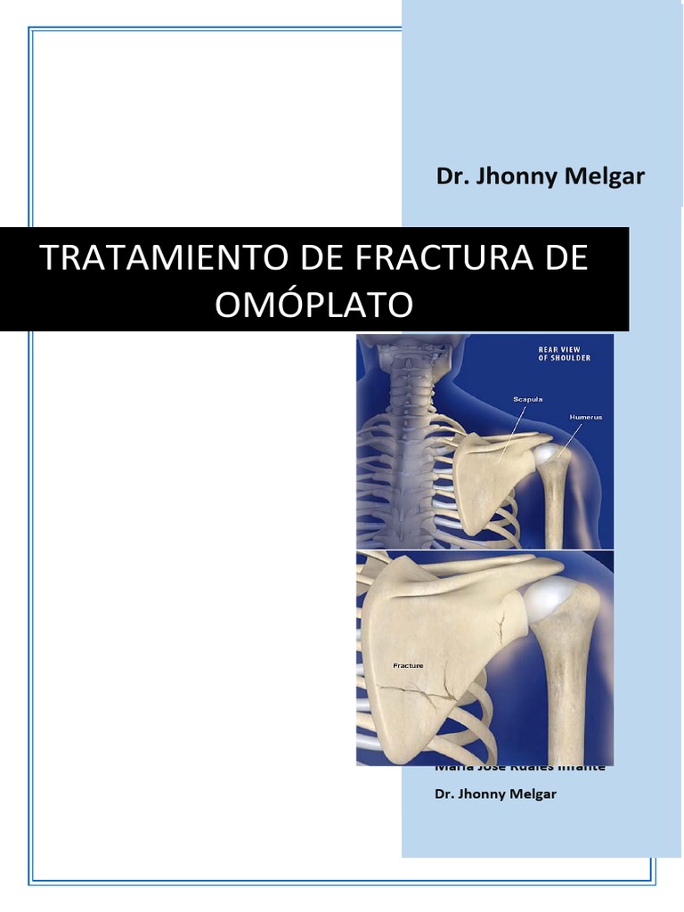 Tratamiento de Fractura Escapular | PDF | Extremidades (anatomía ...
