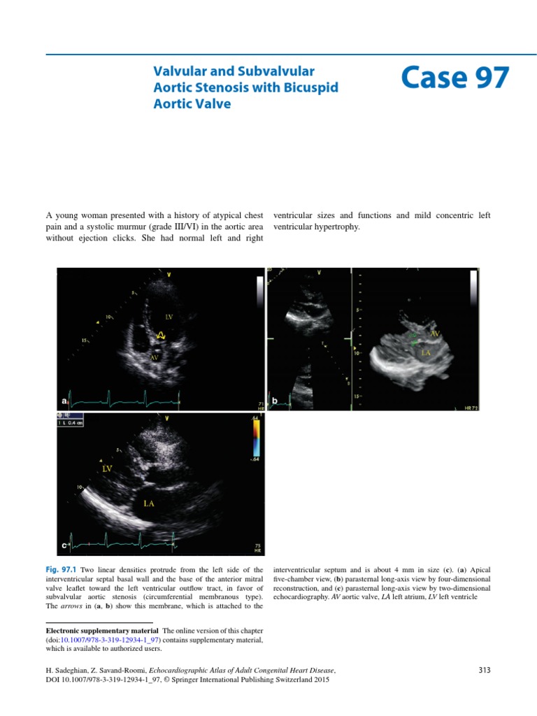 Valvular and Subvalvular Aortic Stenosis With Bicuspid Aortic Valve | PDF | Heart Valve ...