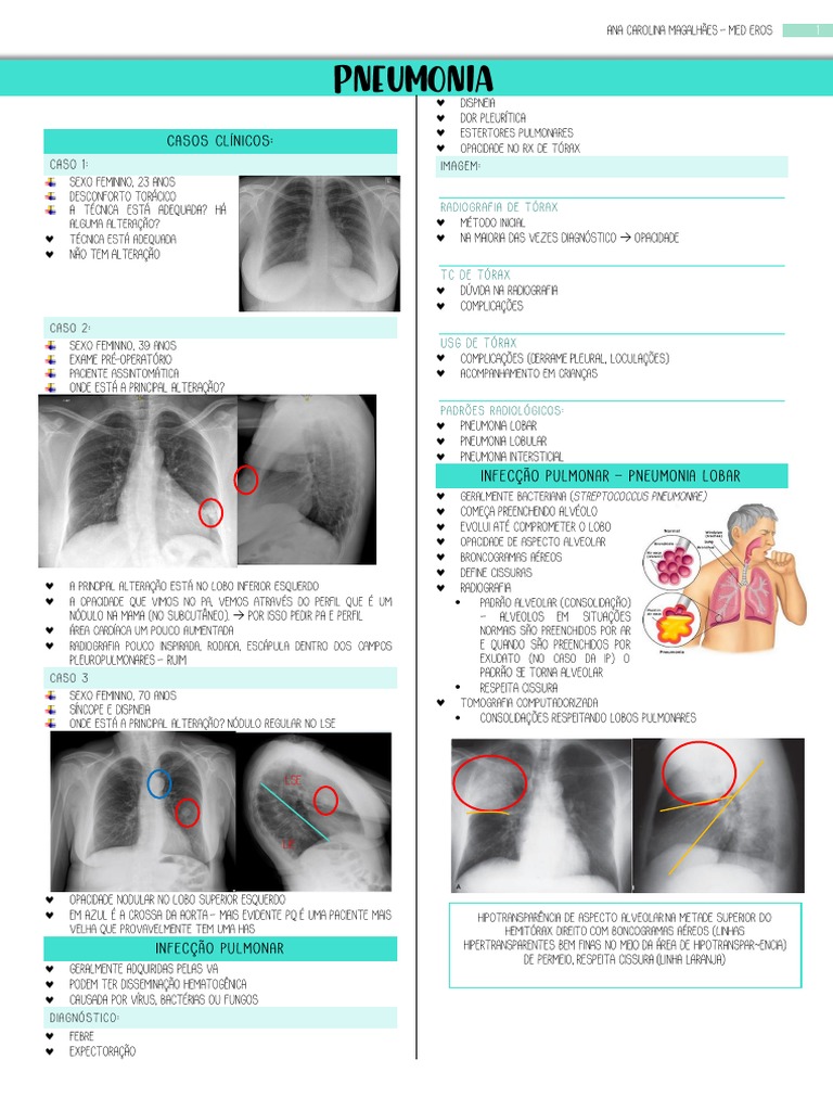 AULA 8 DIAGNÓSTICO - PNEUMONIA | PDF