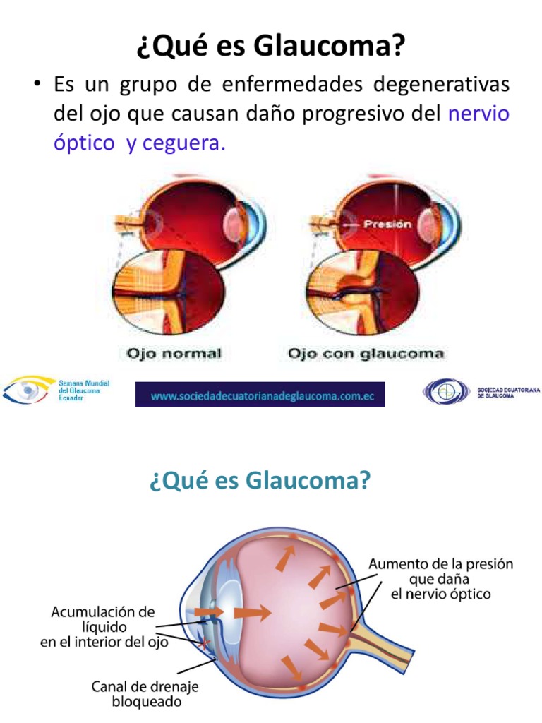CATARATA | PDF | Glaucoma | Ojo humano