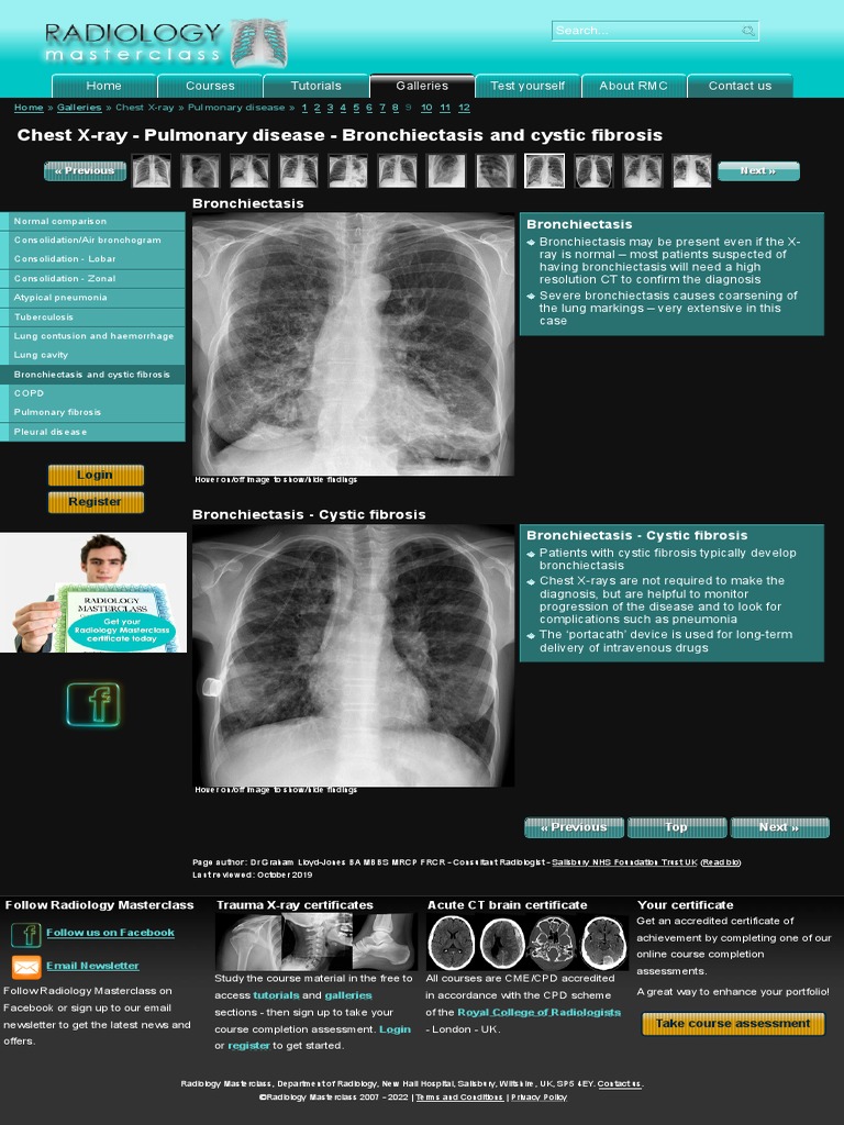 Chest X-Ray - Pulmonary Disease - Bronchiectasis and Cystic Fibrosis | PDF | Radiology ...