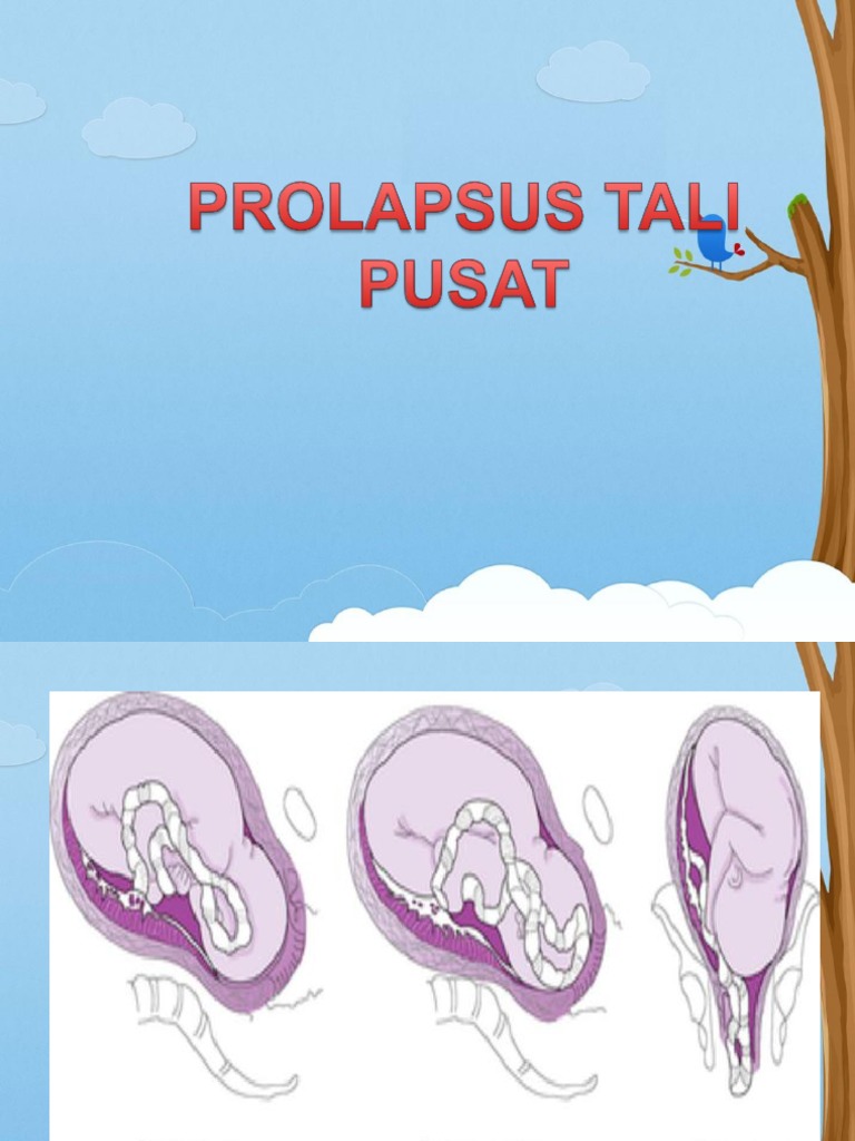 Prolapsus Talipusat | PDF