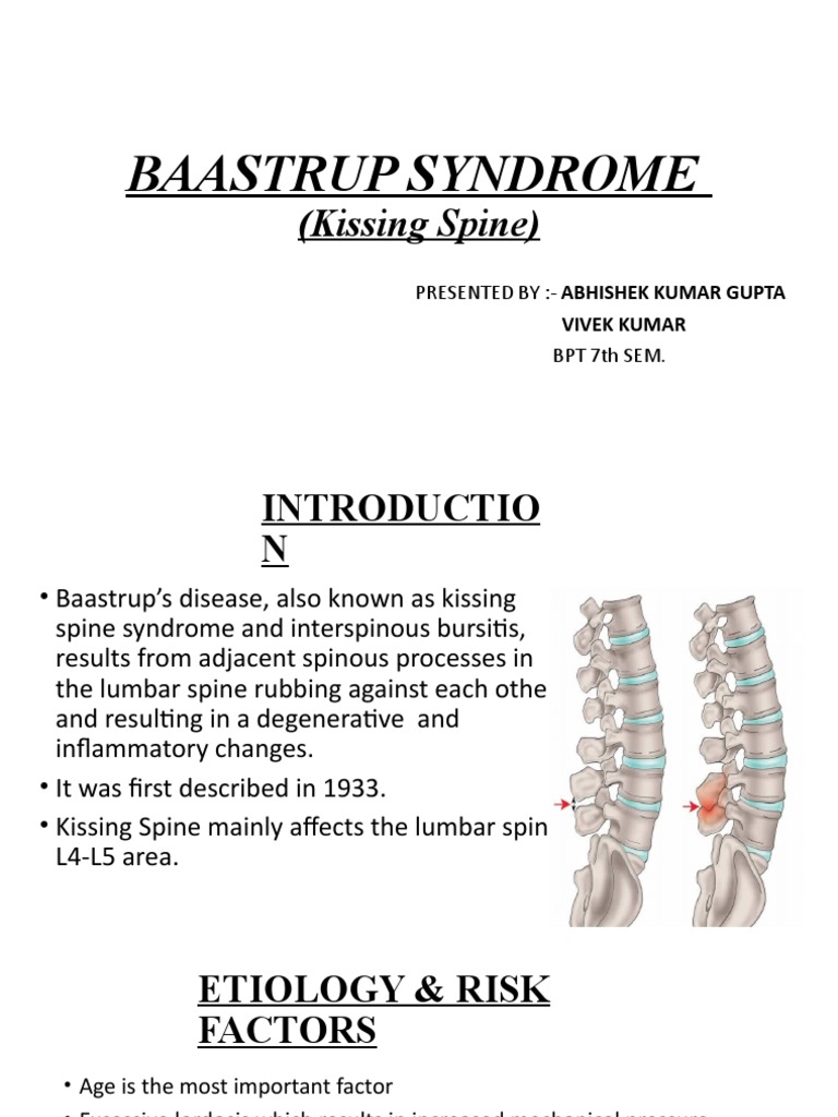 Baastrup syndrome (Kissing spine) | PDF