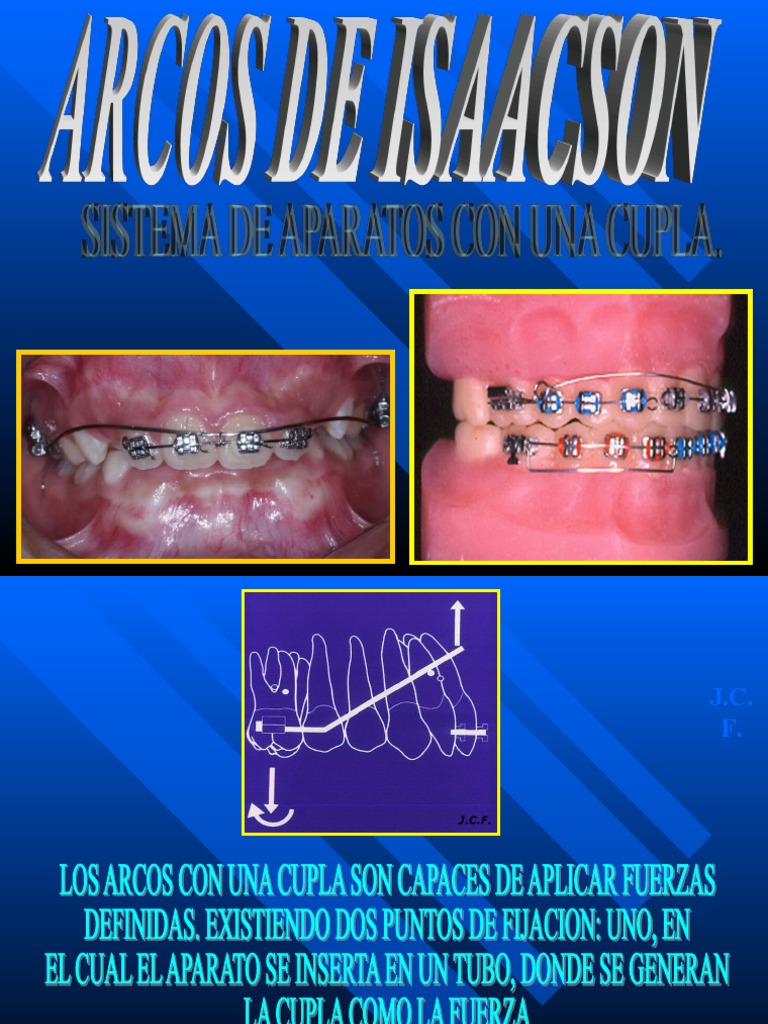 Arcos de Intrusión y Cuplas en Ortodoncia | PDF | Boca | Materiales