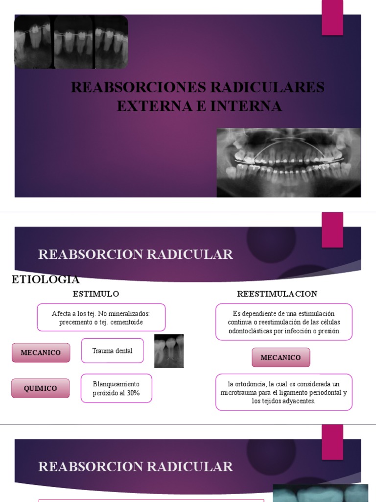 Reabsorcion Radicular | PDF | Especialidades Medicas | Medicina CLINICA