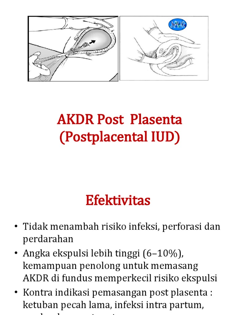Pemasangan AKDR Pasca Plasenta | PDF | Griya & Taman