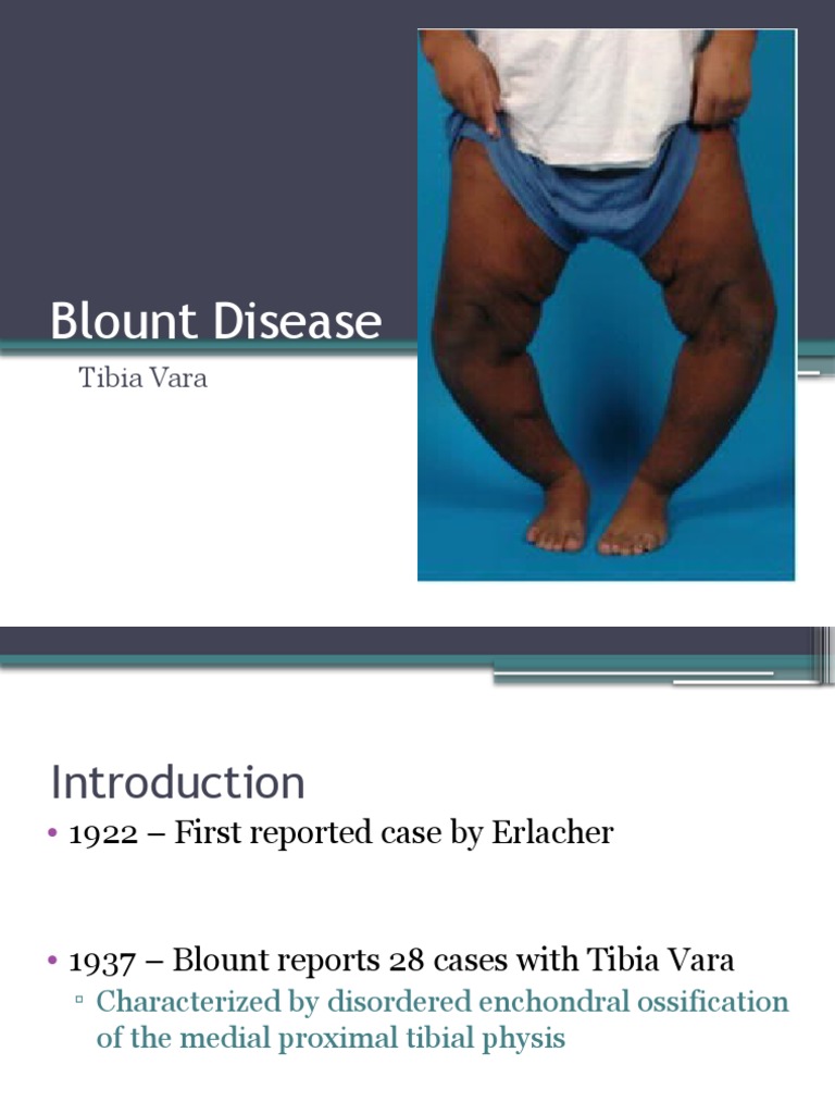 Blount Disease | PDF | Knee | Clinical Medicine
