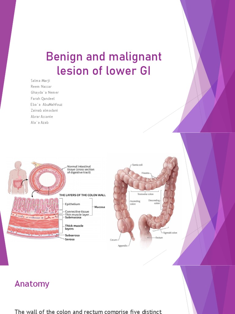Benign and Malignant Lesion of Lower GI | PDF | Colorectal Cancer | Adenoma