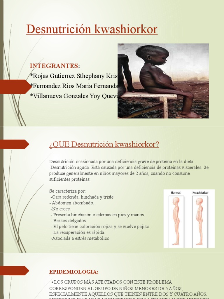 Desnutrición Kwashiorkor | PDF