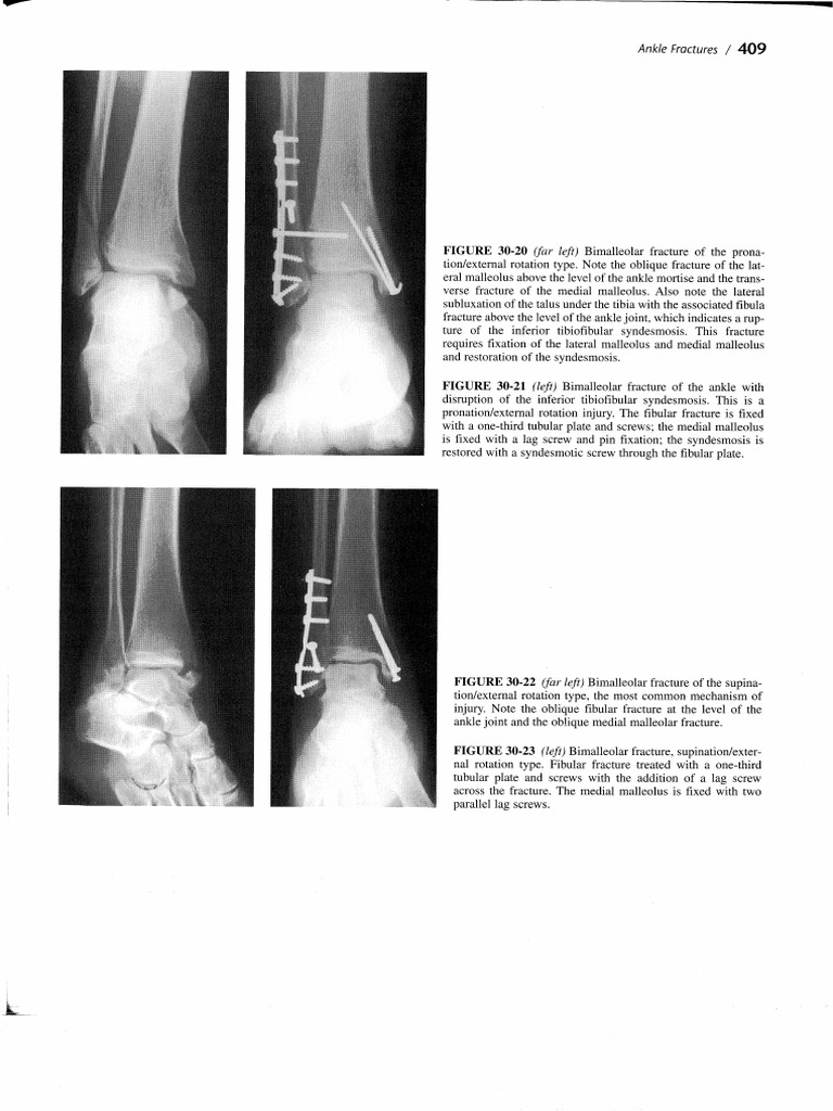 Treatment and Rehabilitation of Fractures (Stanley Hoppenfeld) | PDF