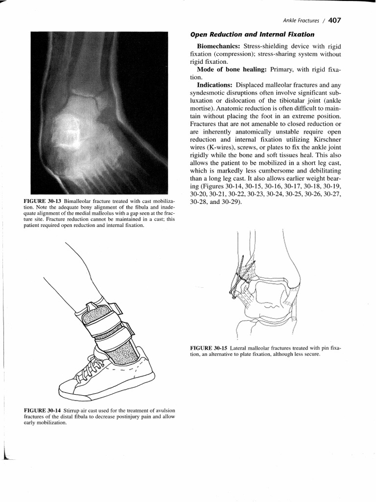 Treatment and Rehabilitation of Fractures (Stanley Hoppenfeld) | PDF ...