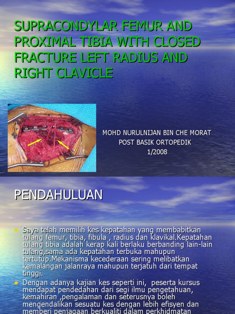 Compound Fracture Left Supracondylar Femur And Proximal Tibia Pdf