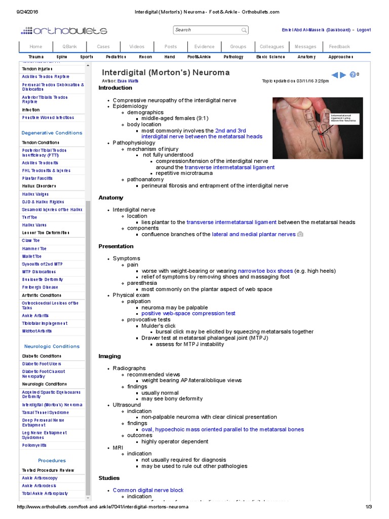 Interdigital (Morton's) Neuroma - Foot & Ankle - Orthobullets ...