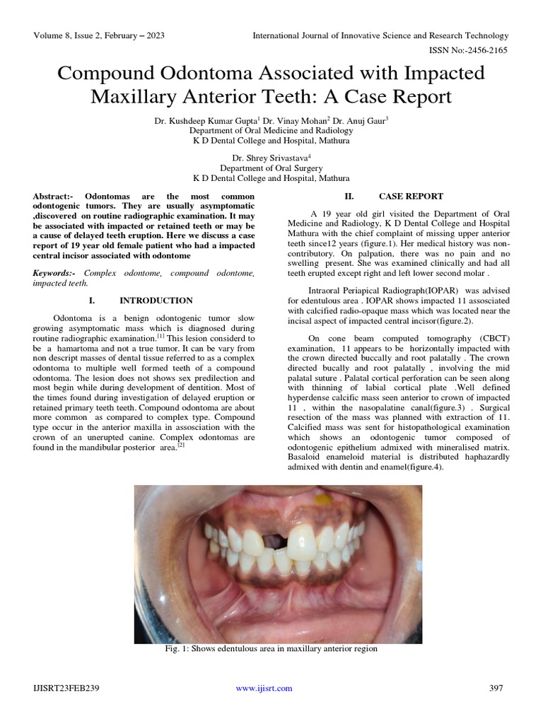 Compound Odontoma Associated With Impacted Maxillary Anterior Teeth A ...