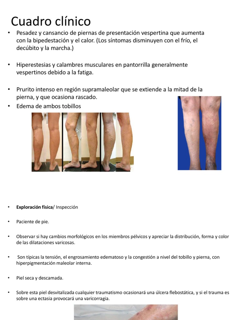 Insuficiencia Venosa Venas Varicosas Diagnostico Medico Prueba