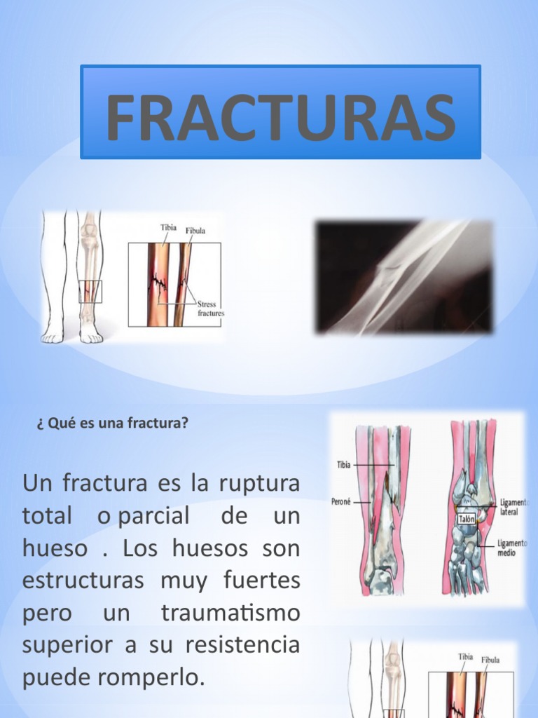 Fracturas | PDF