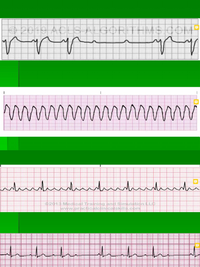Aritmia Acls Soal Ecg | PDF