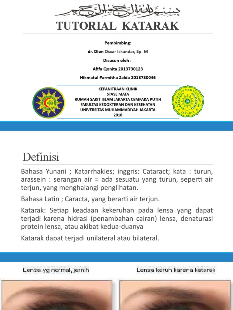 Tutorial Katarak | PDF