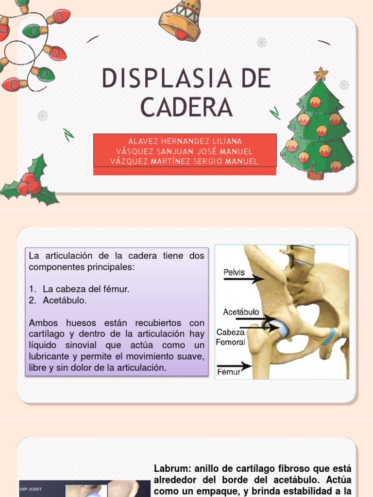Displasia de Cadera: Causas y Tratamiento | PDF | Articulación ...